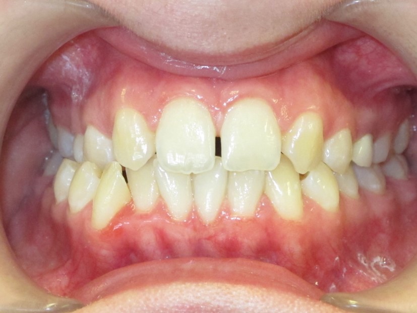 Avant / Après orthodontie - Dr Ramon & Dr Darmon-Lahmi